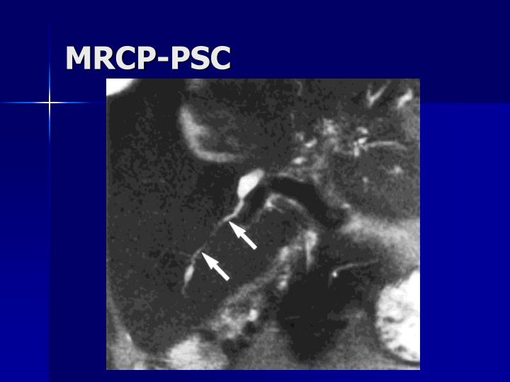 PPT - Primary Sclerosing Cholangitis and Primary Biliary Cirrhosis ...