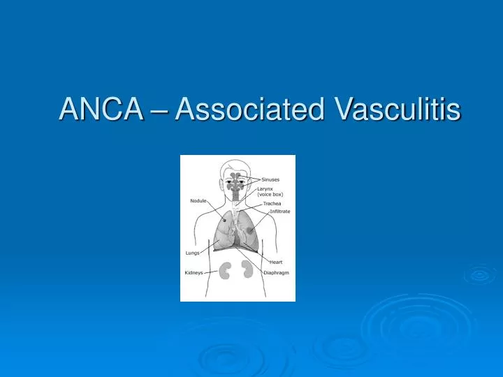 PPT - ANCA – Associated Vasculitis PowerPoint Presentation, free ...