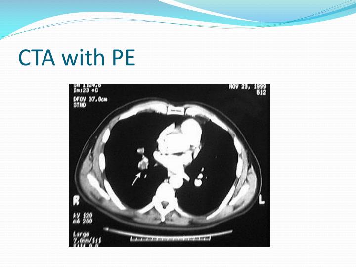 PPT - Pulmonary Embolism PowerPoint Presentation - ID:6594617