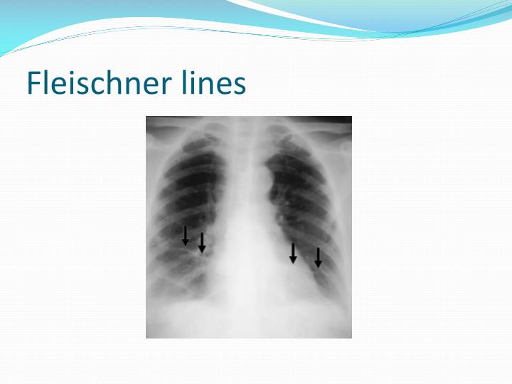 PPT - Pulmonary Embolism PowerPoint Presentation - ID:6594617