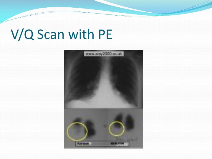 PPT - Pulmonary Embolism PowerPoint Presentation - ID:6594617