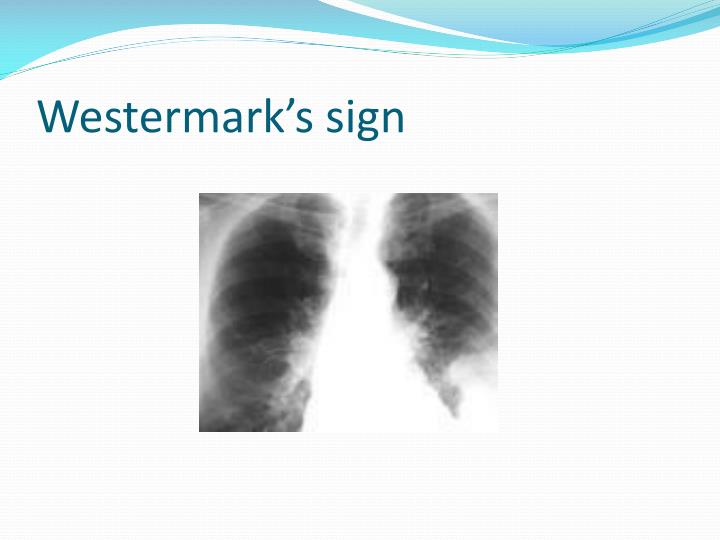 PPT - Pulmonary Embolism PowerPoint Presentation - ID:6594617
