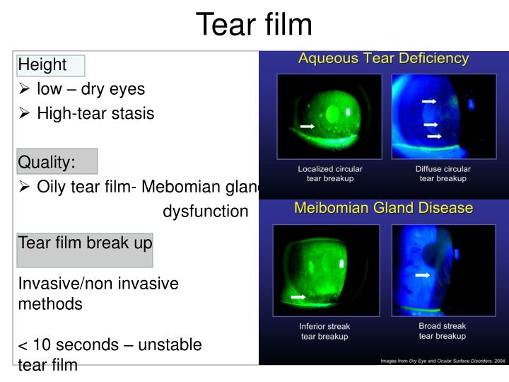 PPT - Dry eyes PowerPoint Presentation - ID:6594786