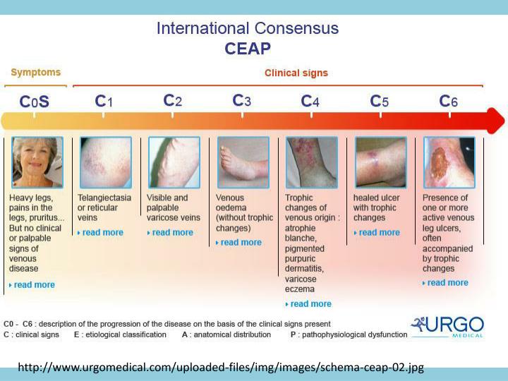 PPT - VENOUS INSUFFICIENCY PowerPoint Presentation - ID:6597718