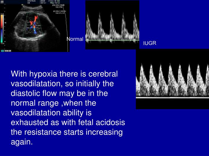 PPT - Middle Cerebral Artery Doppler PowerPoint Presentation - ID:6598483
