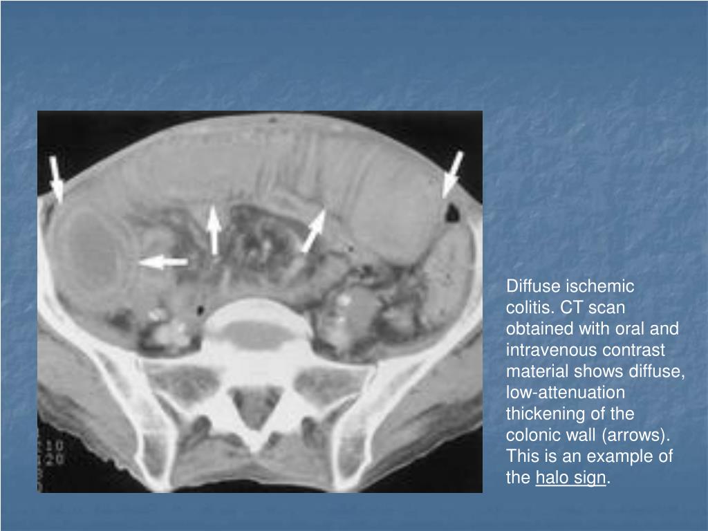 PPT - EVALUACION DEL COLON POR TC: ENFERMEDADES INFLAMATORIAS ...