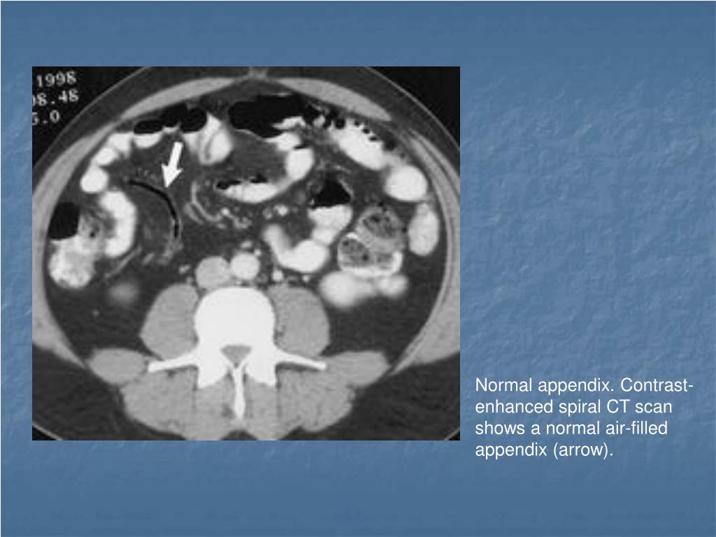 PPT - EVALUACION DEL COLON POR TC: ENFERMEDADES INFLAMATORIAS ...