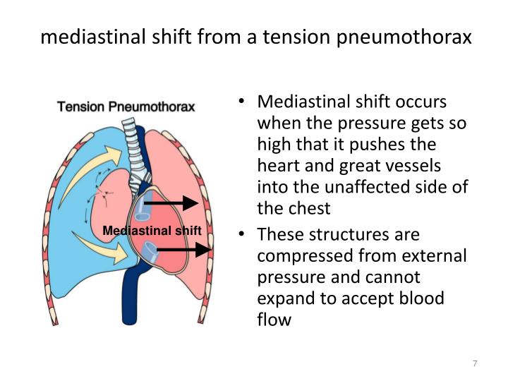 PPT - Thoracic cavity, pleural space PowerPoint Presentation - ID:6598794