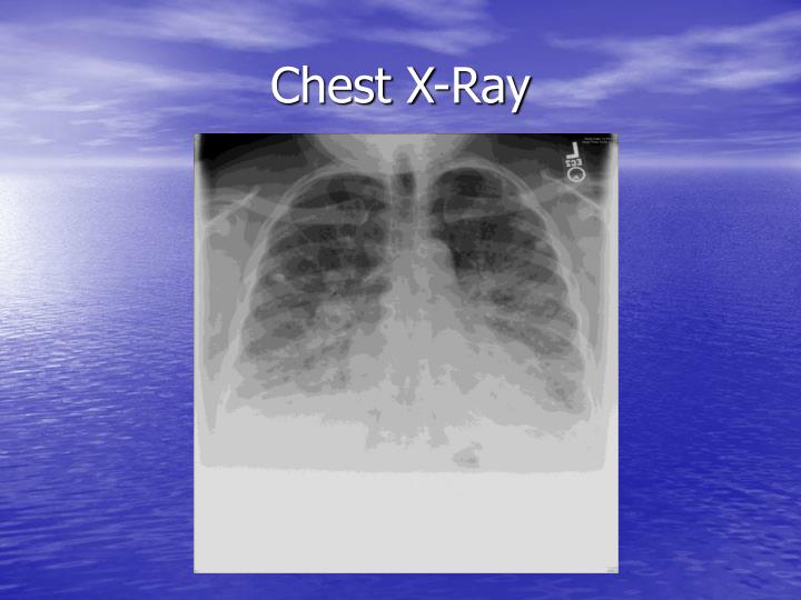 PPT - ST Elevation Myocardial Infarction (STEMI) PowerPoint ...