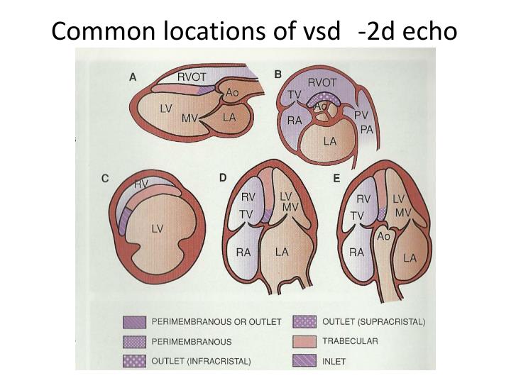 PPT - VENTRICULAR SEPTAL DEFECT PowerPoint Presentation - ID:6600643