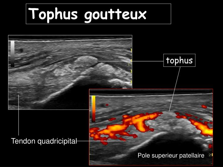 PPT - Le rôle de l’échographie du genou dans les arthropathies ...
