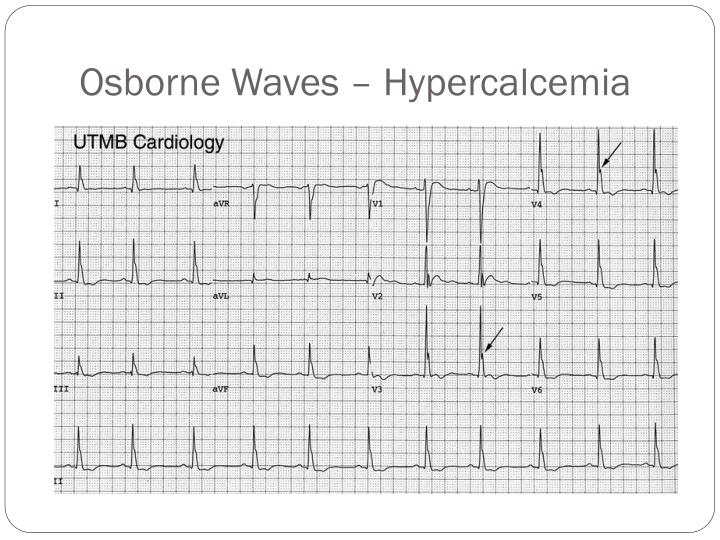 PPT - Cardiac Arrhythmias PowerPoint Presentation - ID:6607564
