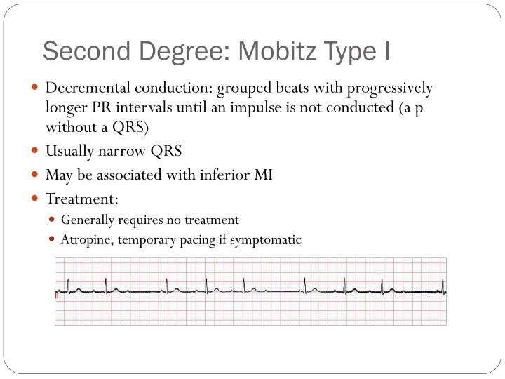 PPT - Cardiac Arrhythmias PowerPoint Presentation - ID:6607564