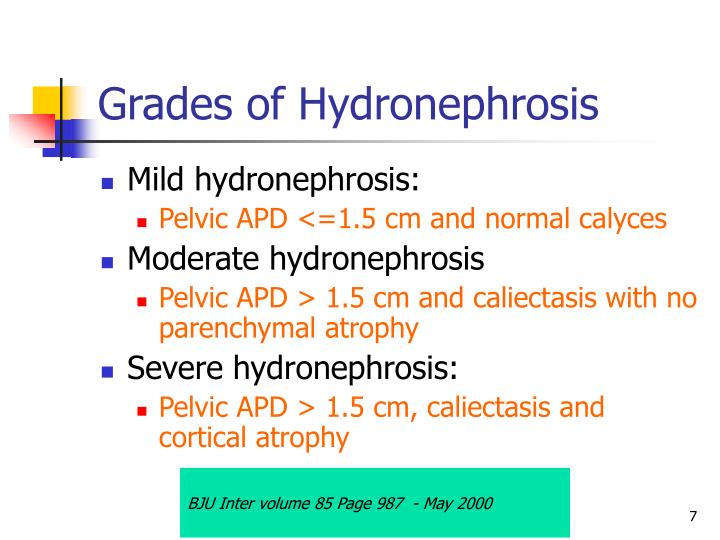 PPT - ANTENATAL HYDRONEPHROSIS PowerPoint Presentation - ID:6609366