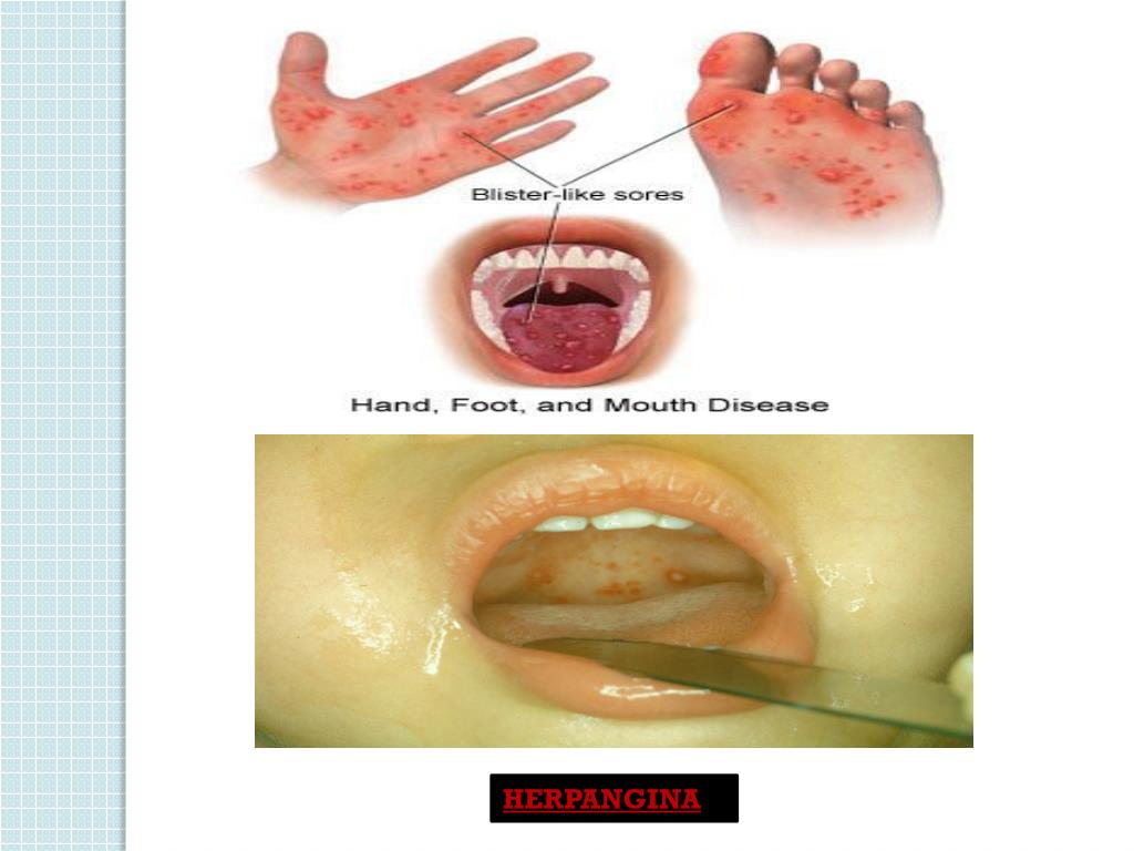 PPT - ORAL MUCOSA DISEASES PowerPoint Presentation, free download - ID ...