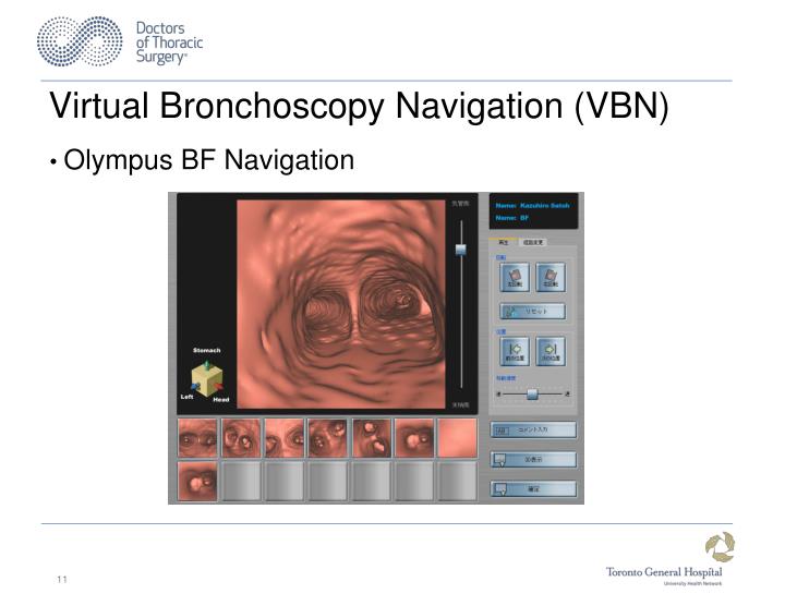 PPT - Navigational Bronchoscopy PowerPoint Presentation - ID:6610626