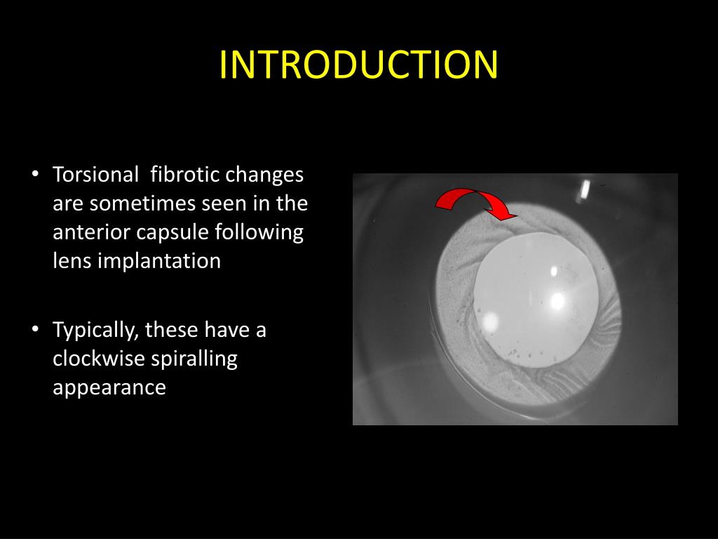 PPT - Torsional fibrosis in the anterior capsule following lens ...