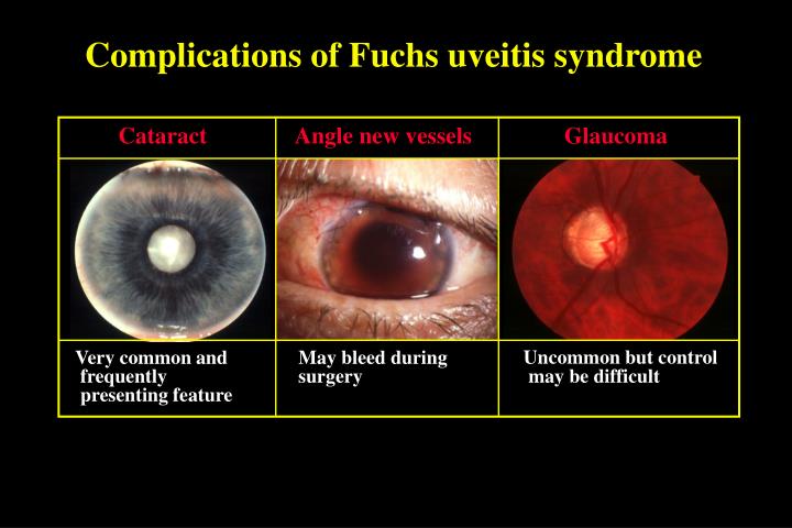 PPT - IDIOPATHIC SPECIFIC UVEITIS SYNDROMES PowerPoint Presentation ...