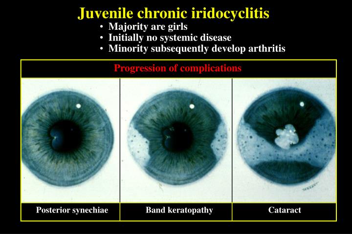 PPT - IDIOPATHIC SPECIFIC UVEITIS SYNDROMES PowerPoint Presentation ...