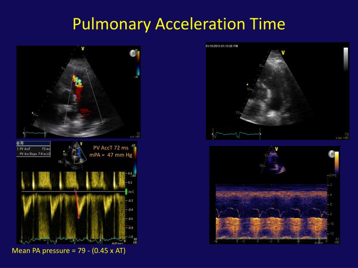 PPT - Role of the Echocardiogram in the Assessment of Pulmonary ...