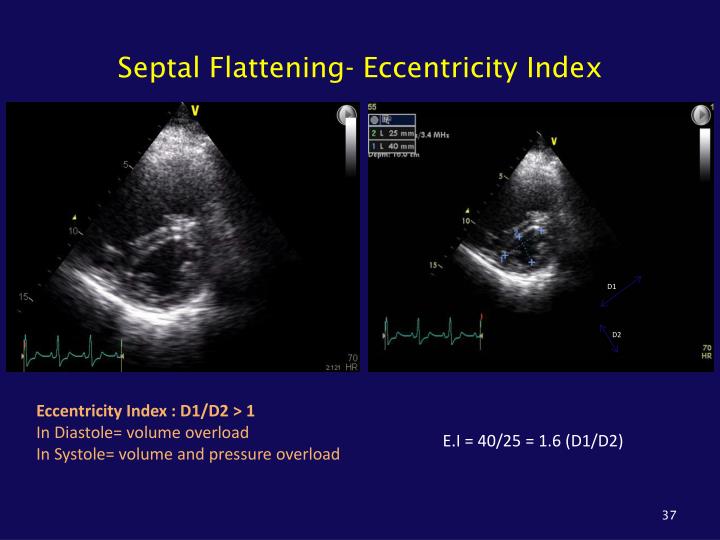PPT - Role of the Echocardiogram in the Assessment of Pulmonary ...