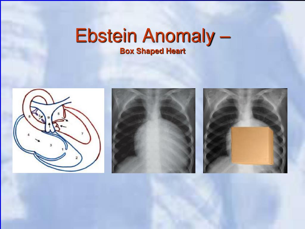 PPT - Chest X-ray signs of cardiac disease PowerPoint Presentation ...
