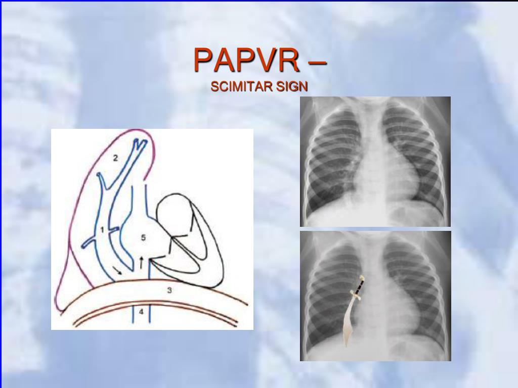 PPT - Chest X-ray signs of cardiac disease PowerPoint Presentation ...