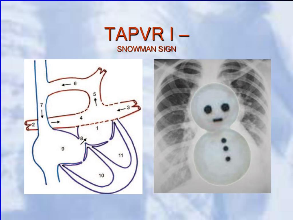 PPT - Chest X-ray signs of cardiac disease PowerPoint Presentation ...
