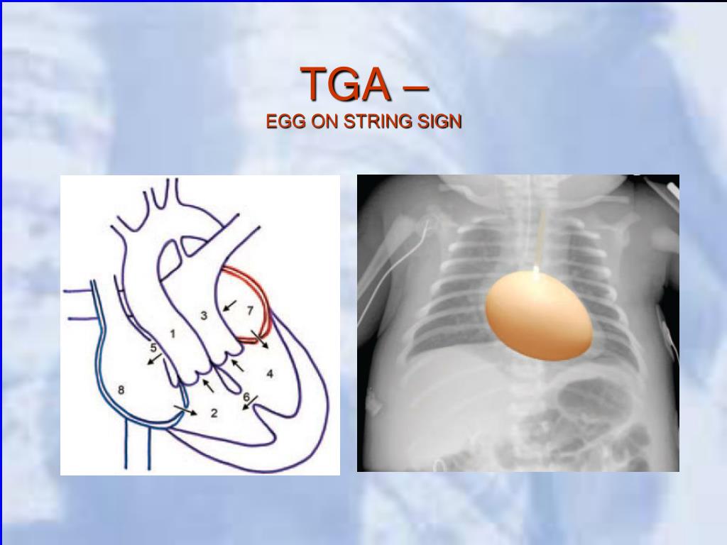 PPT - Chest X-ray signs of cardiac disease PowerPoint Presentation ...