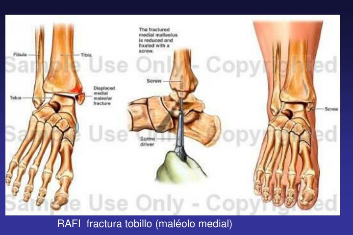 PPT - Procedimientos en Ortopedia PowerPoint Presentation - ID:6620546