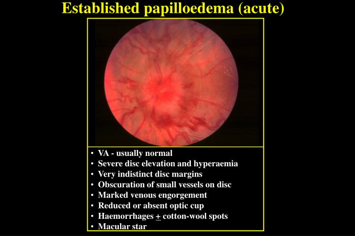 PPT - PAPILLOEDEMA PowerPoint Presentation - ID:6621465