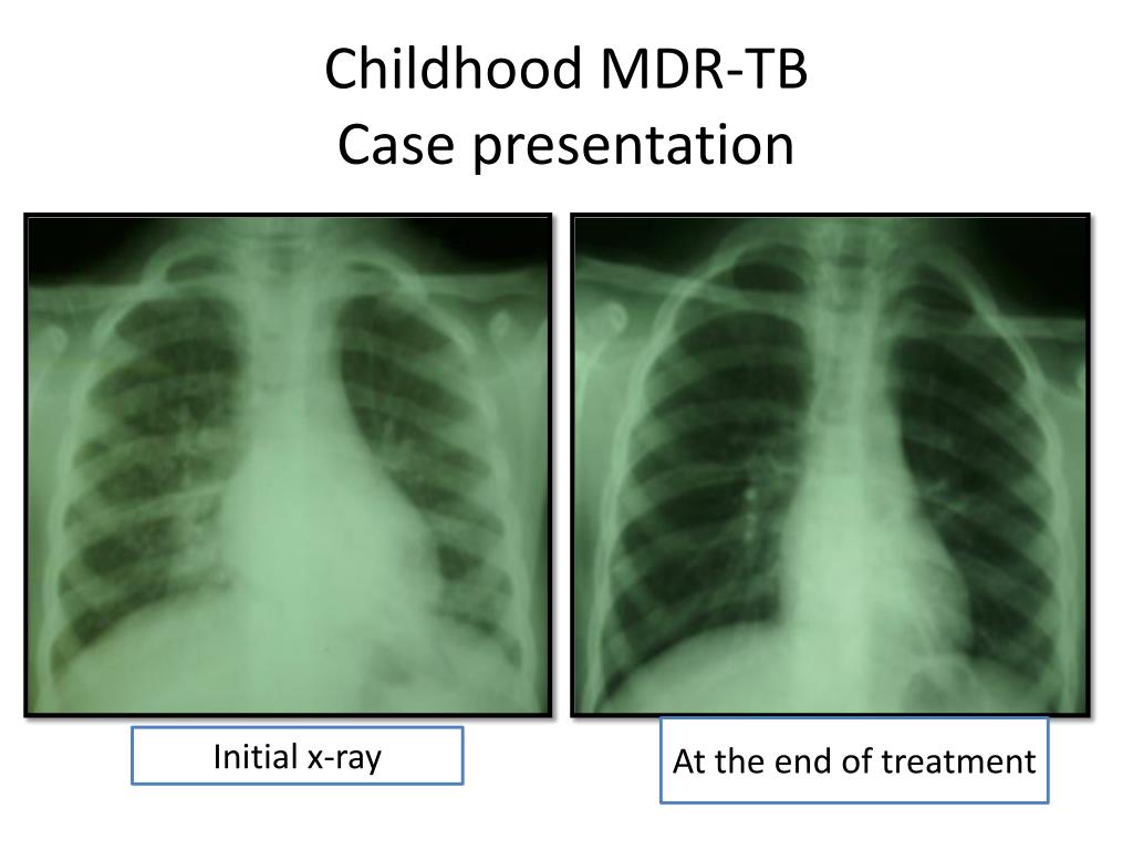 PPT - Management of MDR-TB in Children: Guidelines for Treatment and ...