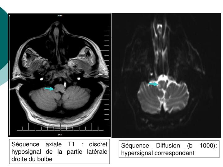 PPT - UNE PARALYSIE DES NERFS MIXTES REVELANT UN INFARCTUS BULBAIRE ...