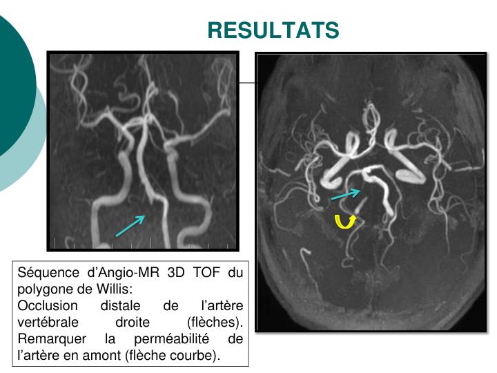 PPT - UNE PARALYSIE DES NERFS MIXTES REVELANT UN INFARCTUS BULBAIRE ...