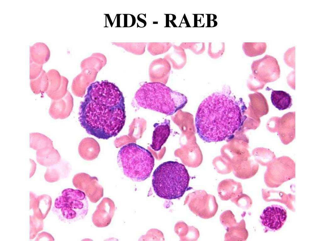 PPT - 骨髓增生异常综合征（ myelodysplastic syndrome, MDS ） PowerPoint ...