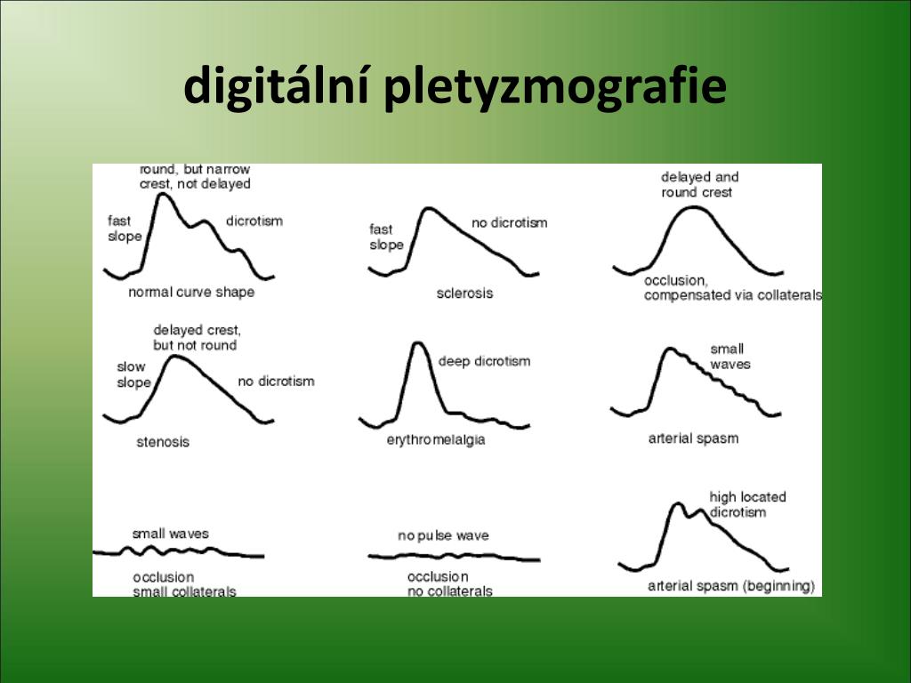 PPT - PLETYSMOGRAFIE V ANGIOLOGII PowerPoint Presentation, free ...