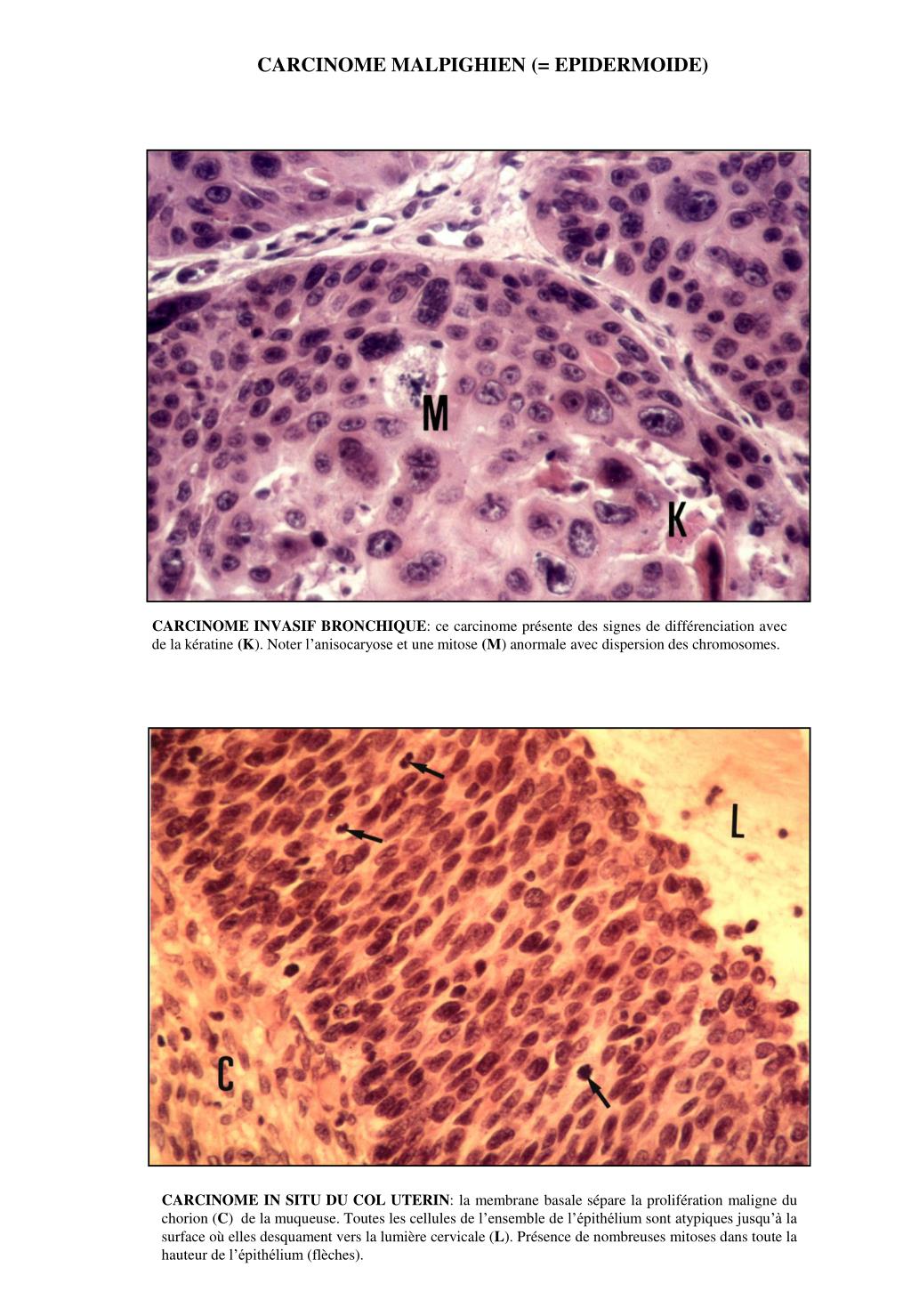 PPT - TUMEUR BENIGNE VRAIE L’ adénome colique PowerPoint Presentation ...