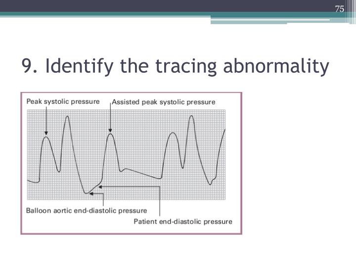 PPT - IABP- Instrumentation , Indications and Complications PowerPoint ...