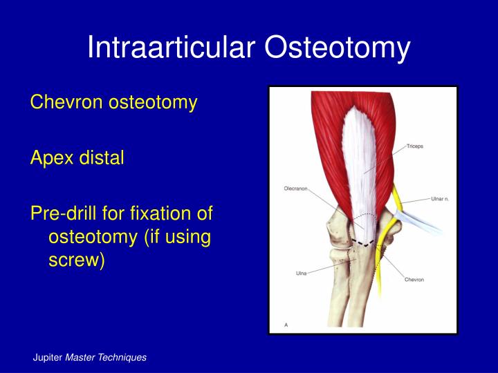 PPT - Distal Humerus Fractures PowerPoint Presentation - ID:6635025
