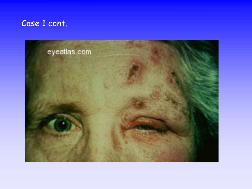 PPT - Shingles & the eye: 3 cases herpes zoster ophthalmicus, HZO David ...