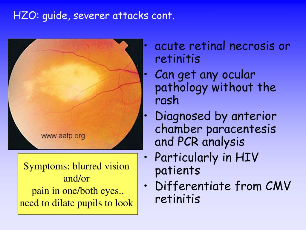 PPT - Shingles & the eye: 3 cases herpes zoster ophthalmicus, HZO David ...
