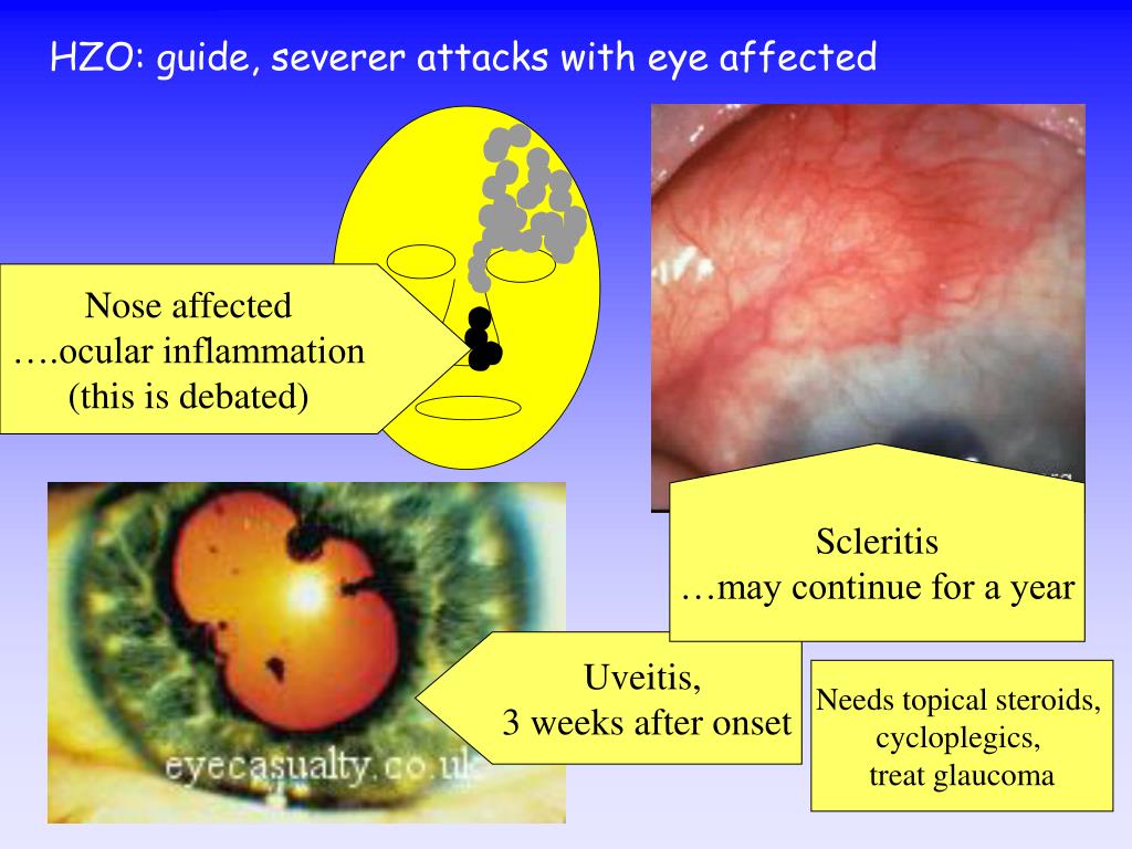 PPT - Shingles & the eye: 3 cases herpes zoster ophthalmicus, HZO David ...