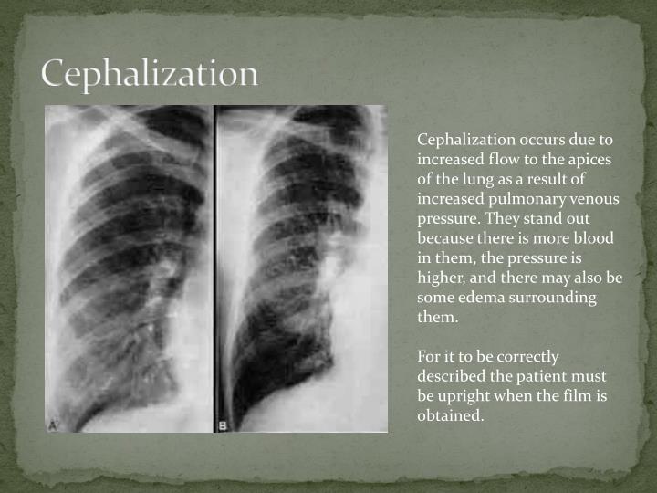 Cephalization Definition Chest X Ray at Frank Jobe blog