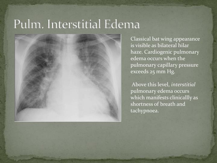 PPT - Diagnostic Radiology: Congestive Heart Failure PowerPoint ...