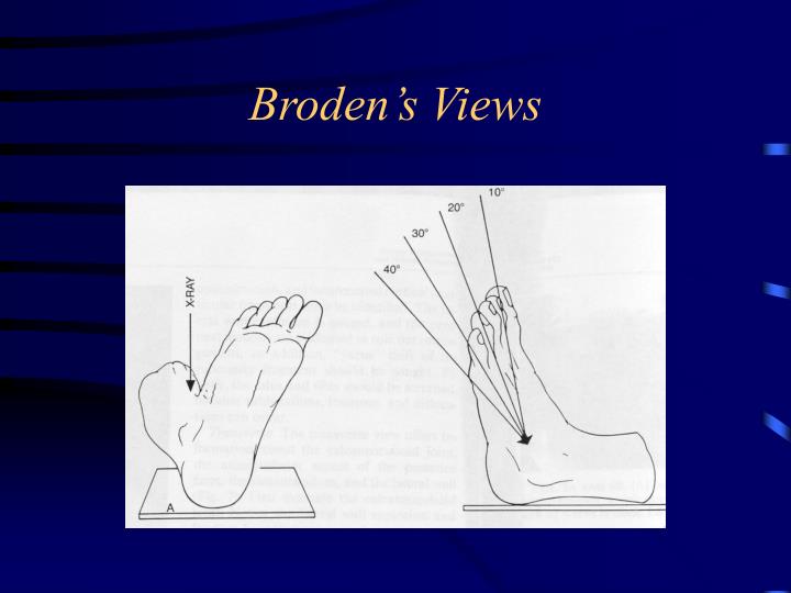PPT - Calcaneus Fractures PowerPoint Presentation - ID:6638785