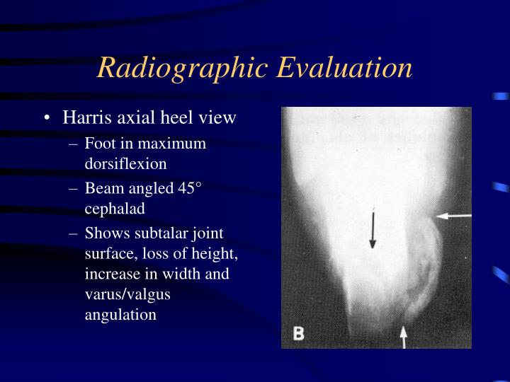 PPT - Calcaneus Fractures PowerPoint Presentation - ID:6638785