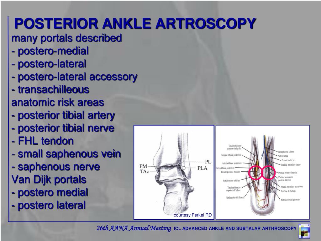 Ppt Advanced Ankle And Subtalar Arthroscopy Use Of Medial Portals In