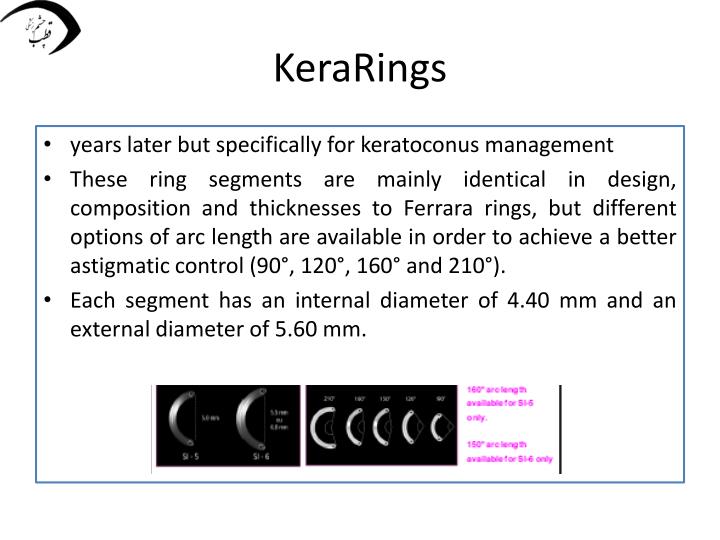 PPT - Intracorneal Ring Segments (ICRS) PowerPoint Presentation - ID ...