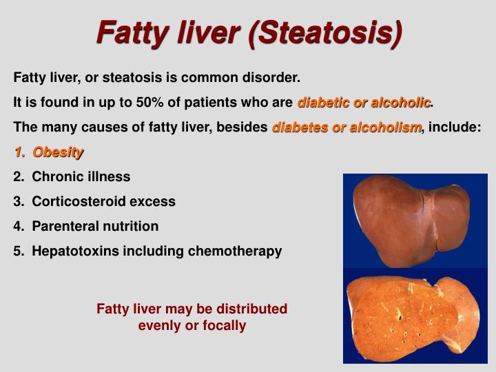 PPT - Diffuse Liver Disease PowerPoint Presentation - ID:6644888
