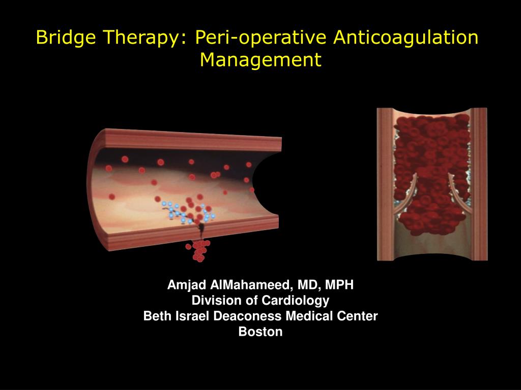 PPT - Bridge Therapy: Peri-operative Anticoagulation Management Amjad ...